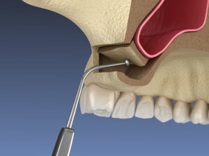 Sinus Lift Techniques: Internal vs. External - Advanced Periodontics of ...